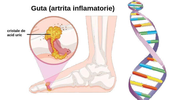 ACIDUL URIC: clarificarea confuziilor privind guta și acest antioxidant
